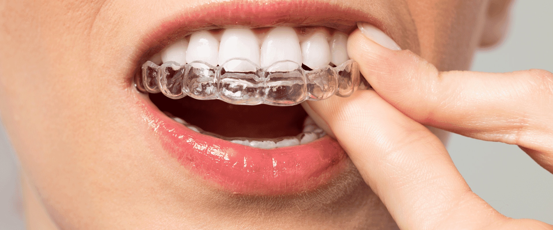 Getting Started with Invisalign Treatment: A Step-by-Step Guide